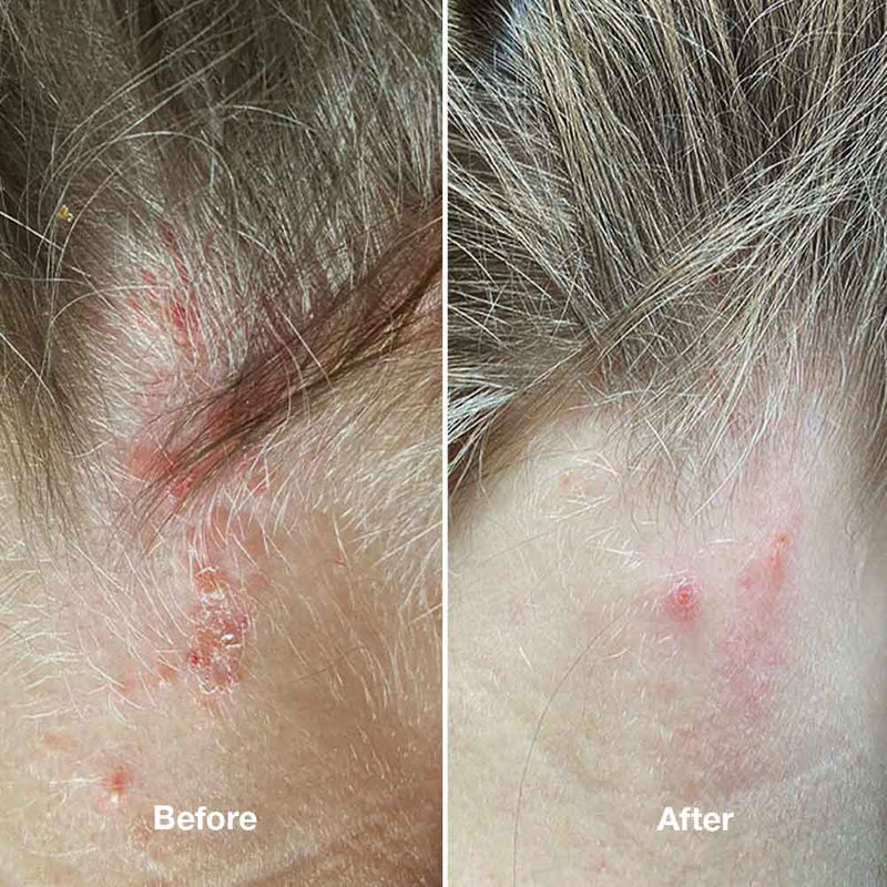 Healpsorin Scalp and Hair Set for Dandruff, Psoriasis and Seborrheic ...