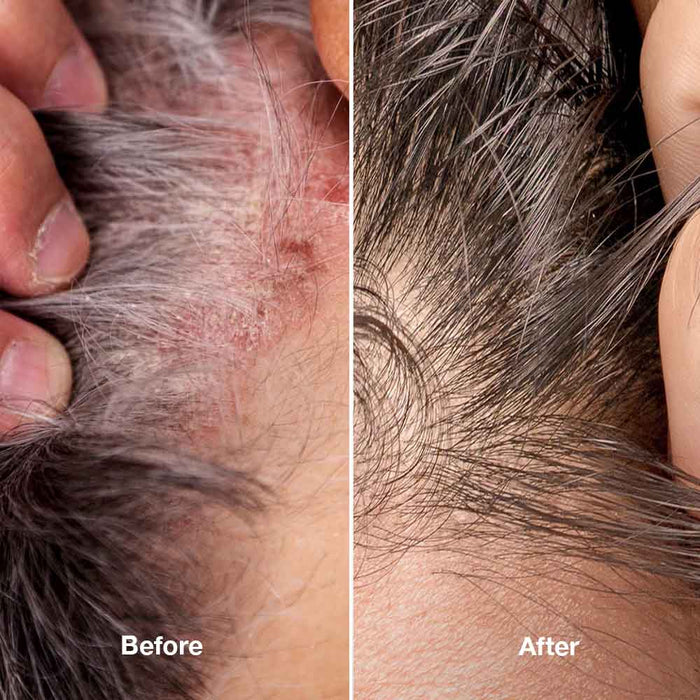 Healpsorin Scalp and Hair Set for Dandruff, Psoriasis and Seborrheic ...